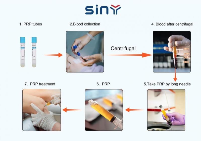 PRP Procedures with Biotin-Enhanced Blood Collection Tubes